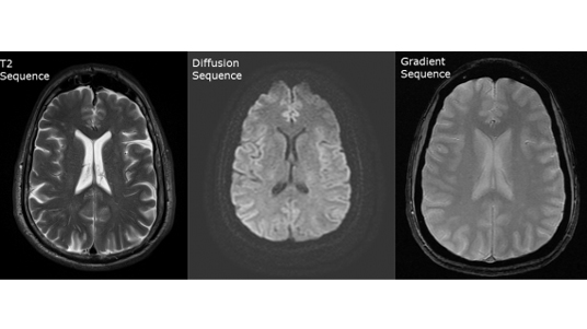 The importance of a 3D T1 sequence - Cortechs.ai