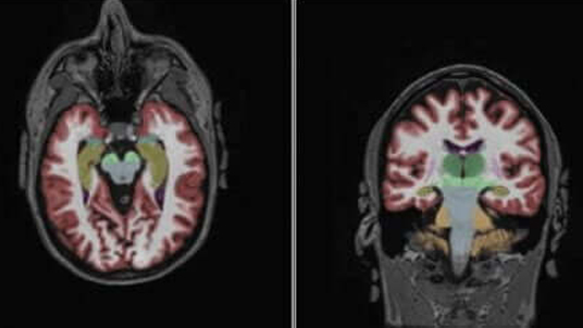 Epilepsy Brain Mri Magnetization Transfer MR Imaging In Patients With