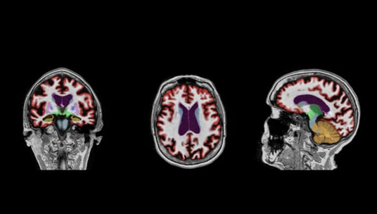 NeuroQuant 4.0: Improved segmentation - Cortechs.ai NeuroQuant 4.0: Improved segmentation - Cortechs.ai