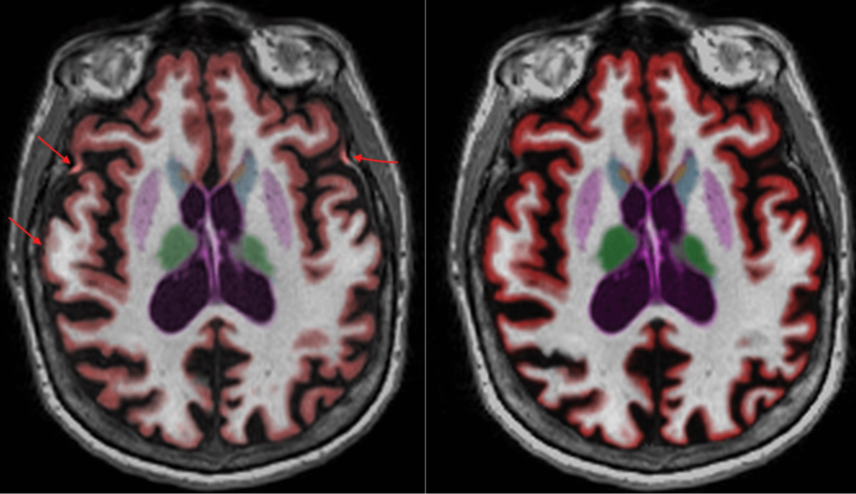 NeuroQuant 4.0: TBA Report updates - Cortechs.ai