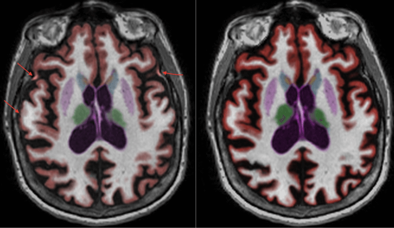 NeuroQuant 4.0: TBA Report Updates & Traumatic Brain Injuries - Cortechs.ai