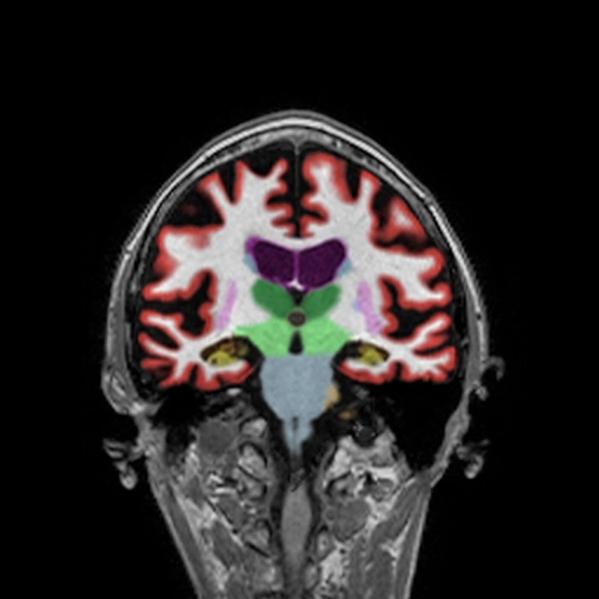 Identifying Alzheimer’s disease with NeuroQuant - Cortechs.ai