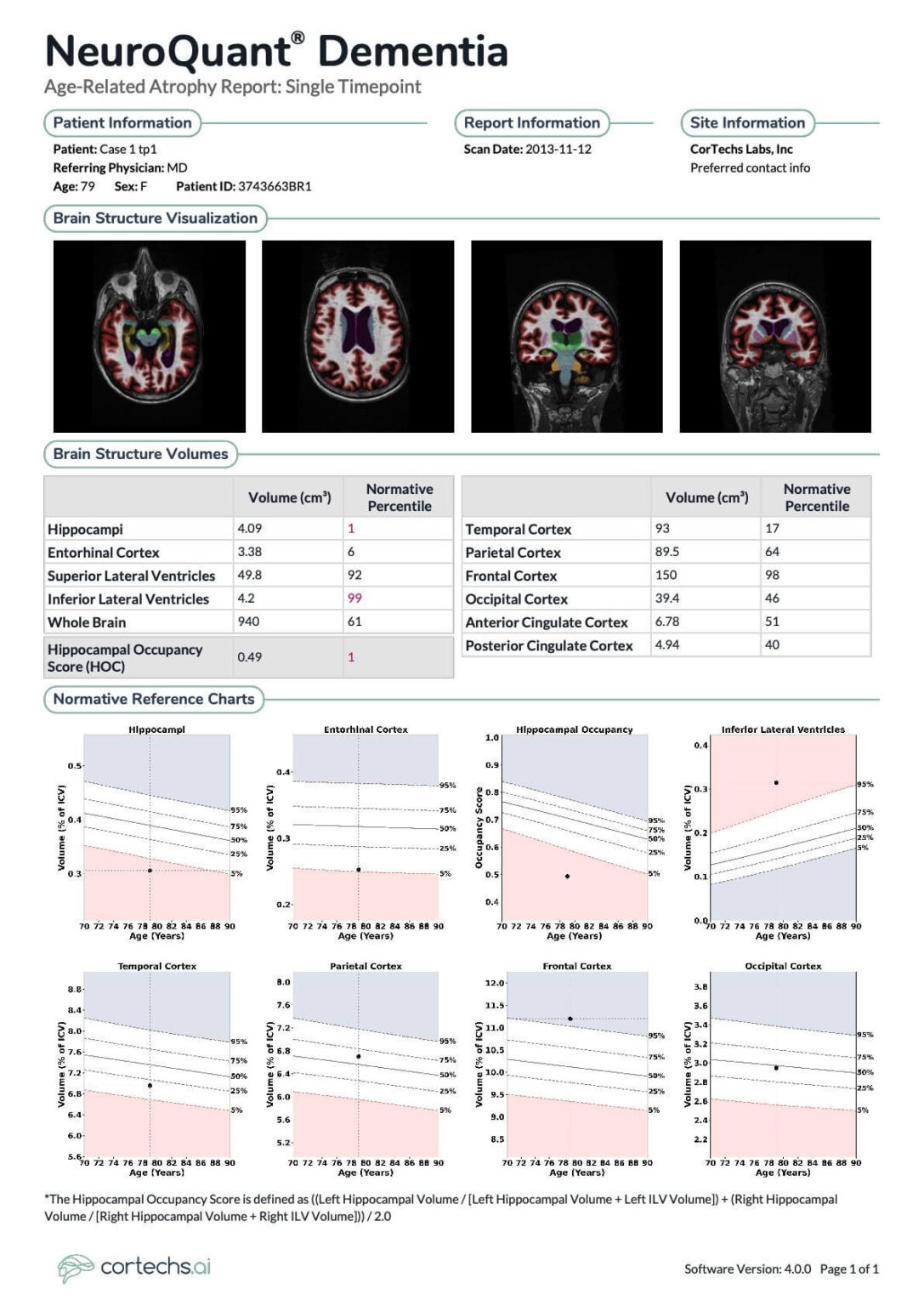 Identifying Alzheimer’s disease with NeuroQuant - Cortechs.ai