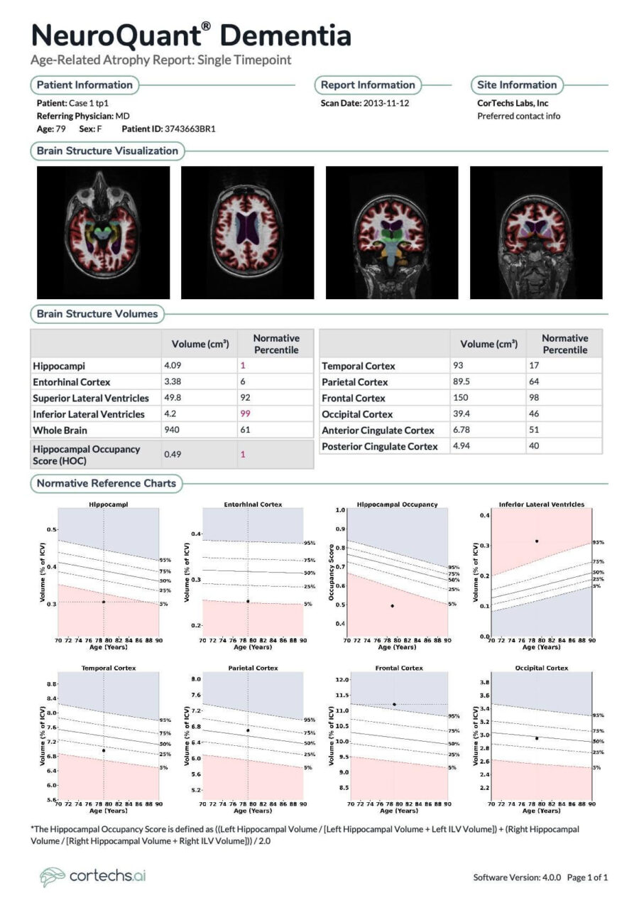 Identifying Alzheimer’s disease with NeuroQuant - Cortechs.ai