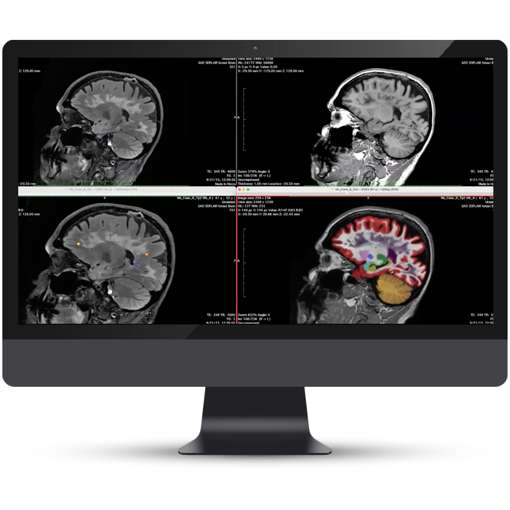NeuroQuant - Cortechs.ai