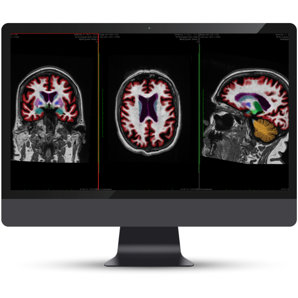 NeuroQuant - Cortechs.ai